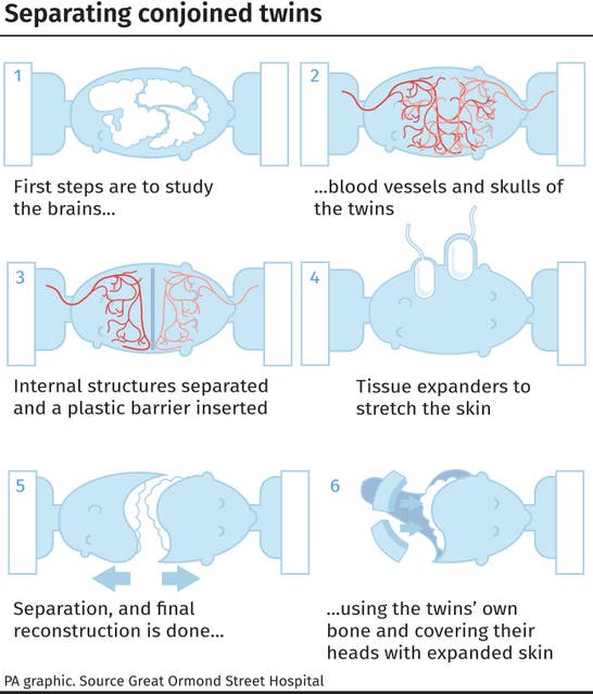 How did surgeons in London separate conjoined twins? | The National